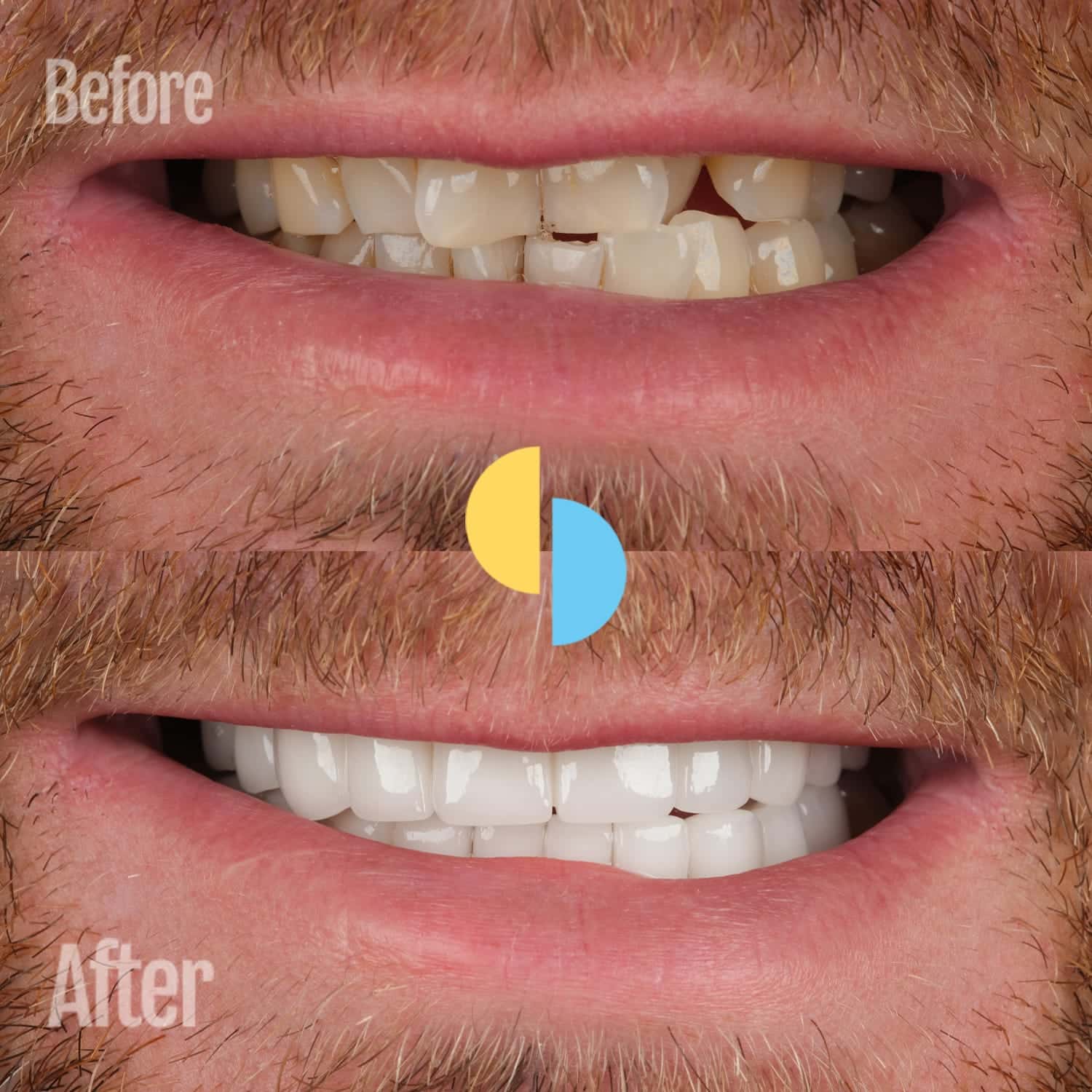 Crossbite Before After Pictures